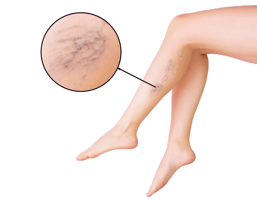 Varicose Veins in Korea - Achieve healthy and beautiful legs - SH Clinic